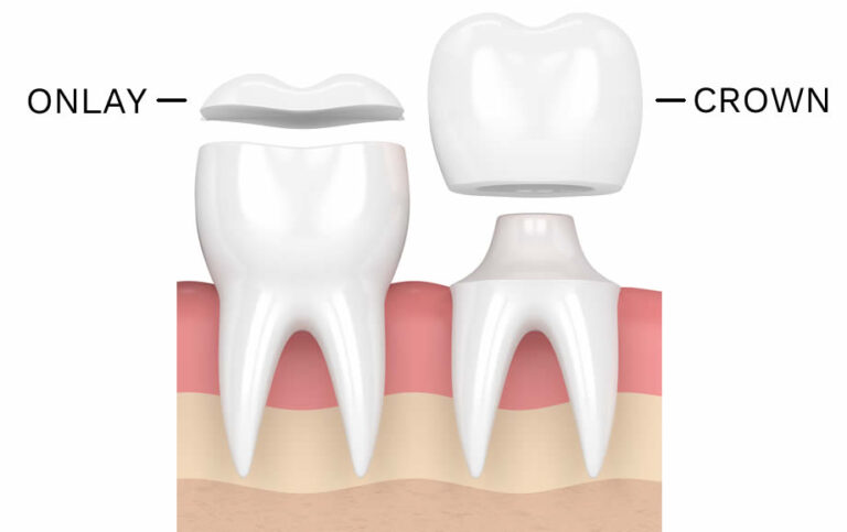 Tooth Crowns - Didcot Dental Studio | Teeth Restored