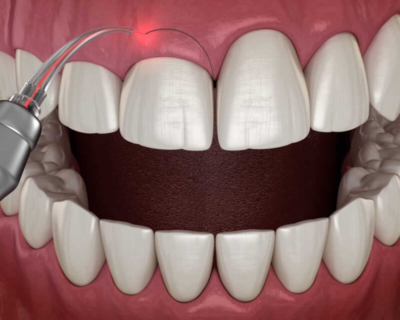 Gum Treatments Didcot, Oxfordshire | Didcot Dental Studio