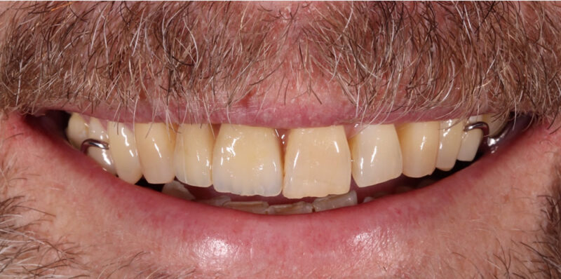 Comfortable Dentures - Didcot Dental Studio Oxfordshire