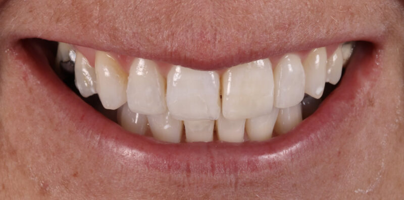 Invisalign - Didcot Dental Studio | Discreet Straight Teeth